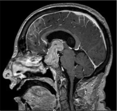 Coronal And Sagittal Contrast Enhanced T1 Weighted Magnetic Resonance