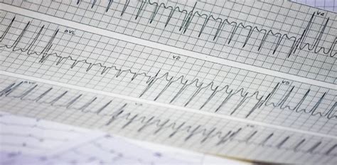 Mastering Acls Rhythm Strips Take The Ultimate Quiz