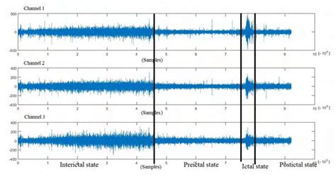 Example Of EEG Signal With Periods Of Epilepsy Broken Down Usman Download Scientific Diagram