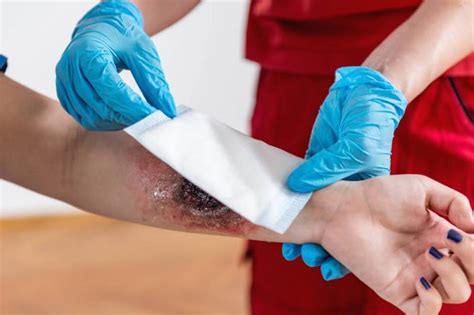 Queimaduras O Que Fazer Dermatologiaesaude Health Que
