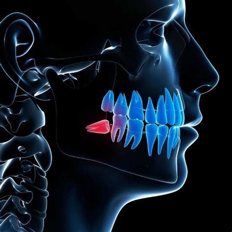 Wisdom Teeth Removal Gladwin Crossing Dental Dentist Abbotsford