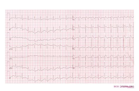 Filebrugada Syndrome Type1 Example6 Ecgpedia