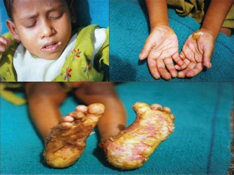 Palmoplanter Keratoderma Ppt