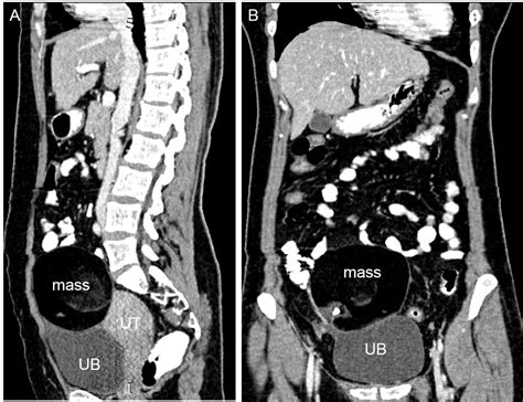 Benign Cystic Ovarian Teratoma Radiology Cases
