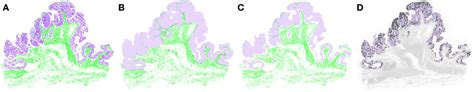 Figure 3 From Deep Convolutional Neural Network Based Lymph Node Metastasis Prediction For Colon