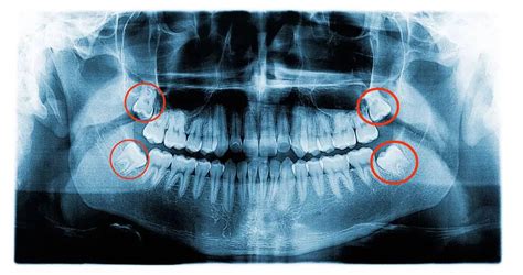 Impacted Wisdom Teeth Causes Signs And Symptoms Dentistryzone