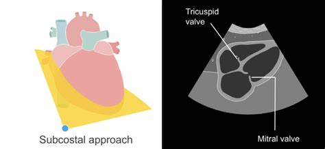 Echo Basics Valve Views • Litfl • Radiology Library