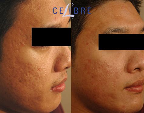 Best Acne Scar Treatment