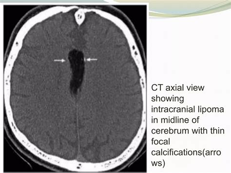 Physiological And Pathological Calcification Of Brain Pptx