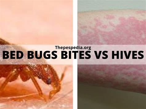 Bed Bug Rash Look Like Vrogue Co