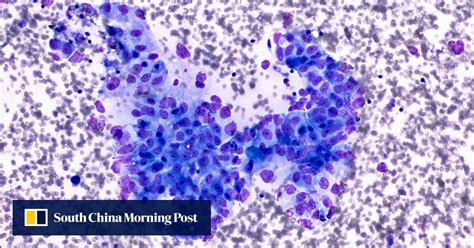 Chinese Scientists Discovery Could Improve Pancreatic Cancer Patients