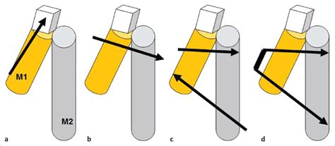 Intra Articular Fractures At The Base Of The First Metacarpal