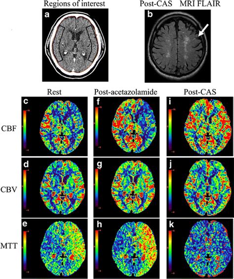 Rois Drawn In A Reference Ct Image A And Cerebral Hyperperfusion