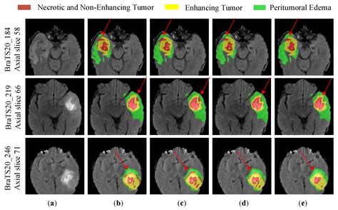 Brain Sciences Free Full Text Brain Tumor Segmentation Network With