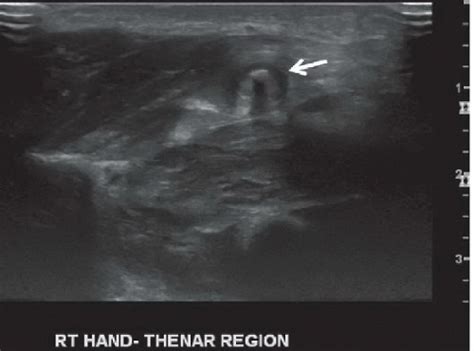 Foreign Body—ultrasound Radiology Key