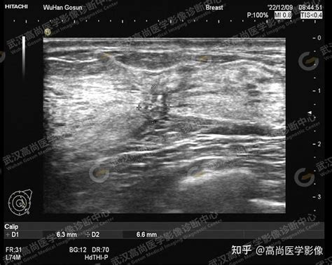 三例乳腺肿块超声诊断病例高尚医学影像 知乎