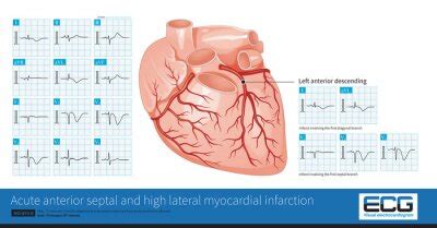 Male 60 Years Old Clinically Diagnosed As Acute Extensive Anterior