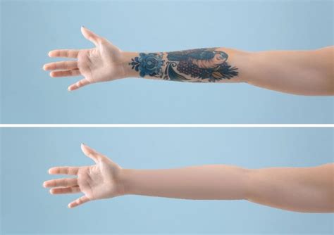 Quelles sont les méthodes pour effacer un tatouage sans se nuire