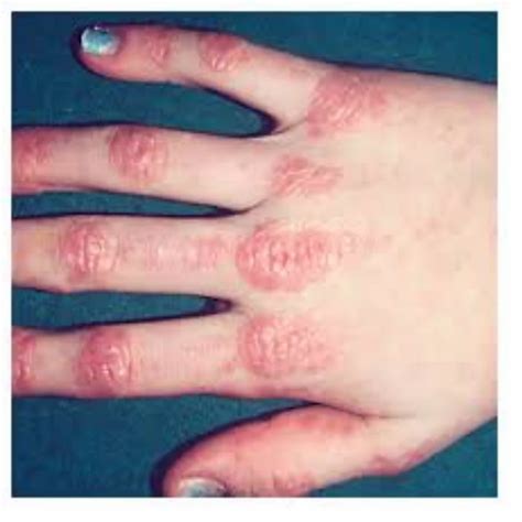 Polymyositis Treatment In Homeopathy At ₹ 2500 Pack In Noida Id 25983708930