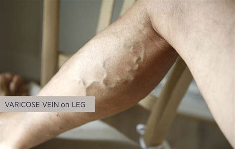 Vascular Ultrasound Of Legs