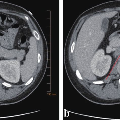 Ct Abdomenpelvis With Contrast A Ct Abdomenpelvis Demonstrated A