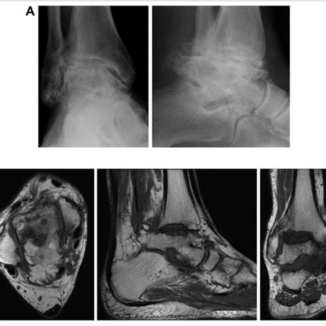 A Anteroposterior And Lateral Radiographs Of The Patient Obtained 4