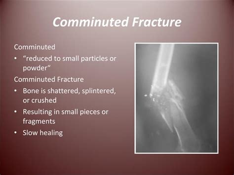 Transverse Fracture Presentation Bio 120 Ppt