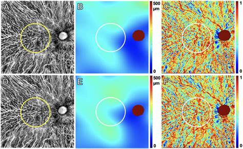 Choroidal Vasculature And Ct Results From Ss Oct 12 × 12 Mm Scans From Download Scientific