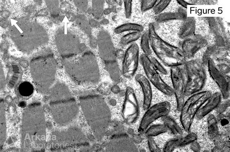 Mitochondrial Abnormalities Neuro Notes With Dr Wilson