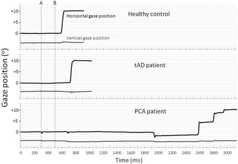 Representative Traces From The Saccade Task For A Healthy Control A Download Scientific