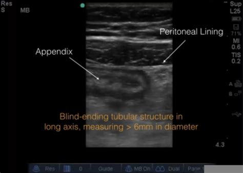 Graded Compression Ultrasound