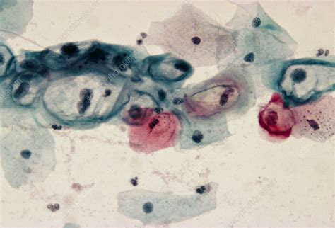 Lm Of Cervical Smear Revealing Hpv Infection Stock Image M8500320