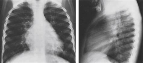 Left To Right Shunt Lesions Thoracic Key