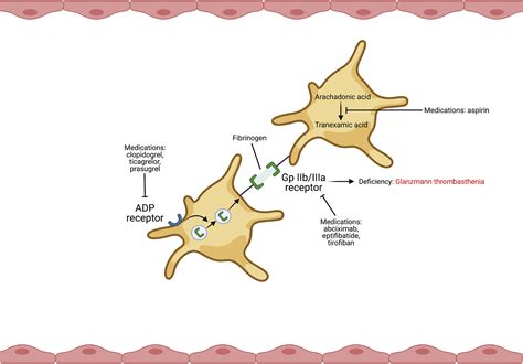 Management Of High Grade Coronary Artery Disease And Concomitant Glanzmann Thrombasthenia Jacc