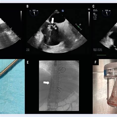 A A Transesophageal Echocardiography Tee Showing A Mobile Structure Download Scientific