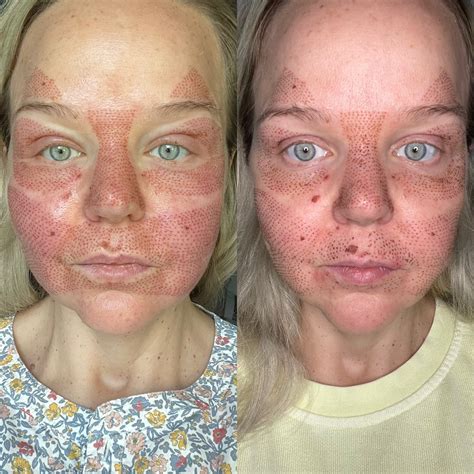Fibroblast Plasma Pen Skin Tightening Part 3 Hibiskus Beauty