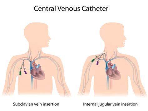 Selection Of Catheter Insertion Site Anesthesiology And Intensive Care