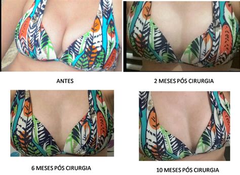 Mamoplastia redutora diário de cirurgia