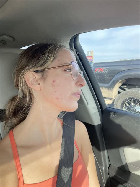 Does This Look Like Purging R Tretinoin