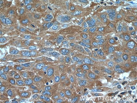 Pfkp Antibody 13389 1 Ap Proteintech