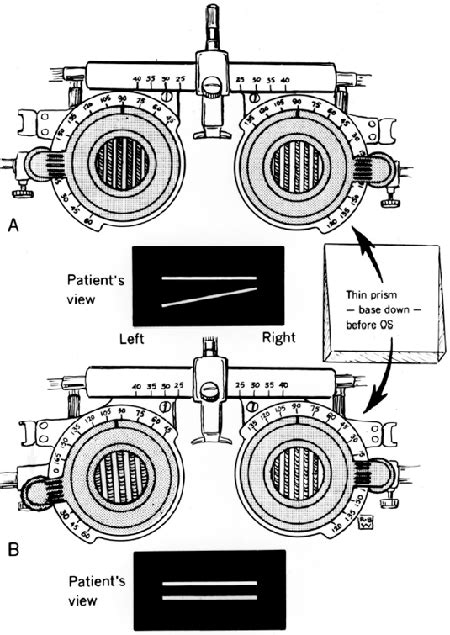 Understanding The Causes Of Vertical Diplopia