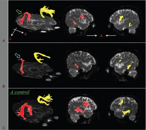 Diffusion Tensor Tractography For The Arcuate Fasciculus Right Af Download Scientific Diagram