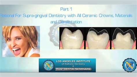 Supra Gingival Restorative Dentistry In The Posterior Part 1 All