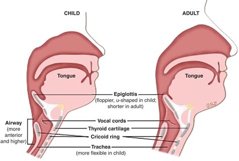 Anterior Larynx Difficult Intubation