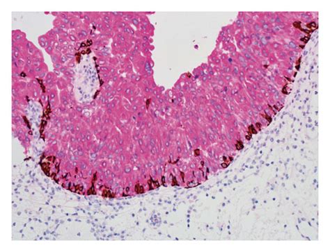 A High Grade Papillary Urothelial Carcinoma B High Grade Papillary Download Scientific