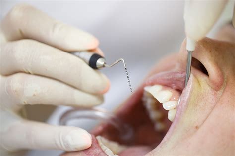 Enfermedad Periodontal Qué Es Y Cómo Prevenirla Clínica Dental Aqua