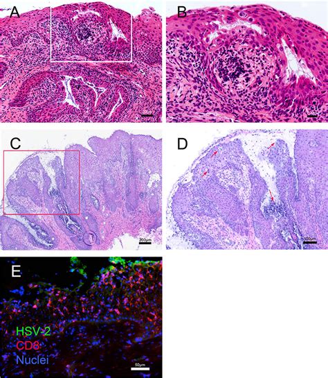 Histopathology And Localization Of Hsv 2 Antigen And Cd8 T Cells In Download Scientific Diagram
