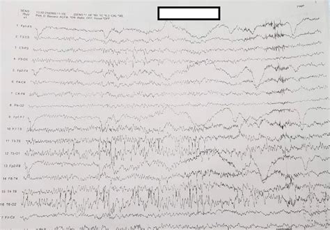Mohibullah Kakar On Linkedin Dr Mohibullah Eeg Seizures Kakar Neurophysiology Center…