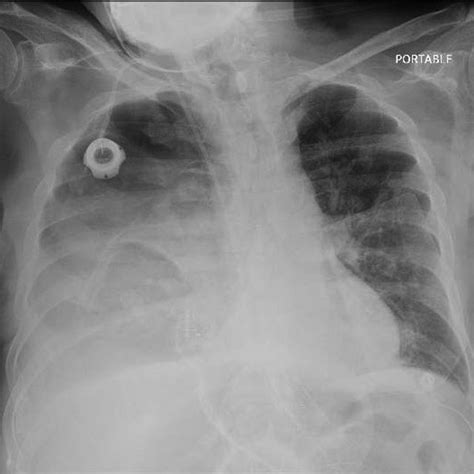 Findings With The Pleural Nodularity Via Thoracic Ultrasound Using The Download Scientific
