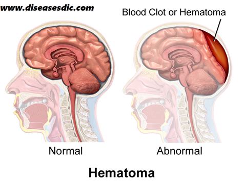 Different Types Of Hematoma Epidural Hematoma Vs Subdural Hematoma Vs
